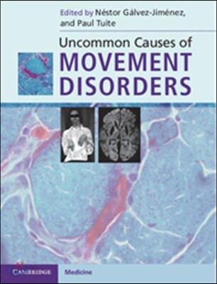 Uncommon Causes of Movement Disorders - 예스24