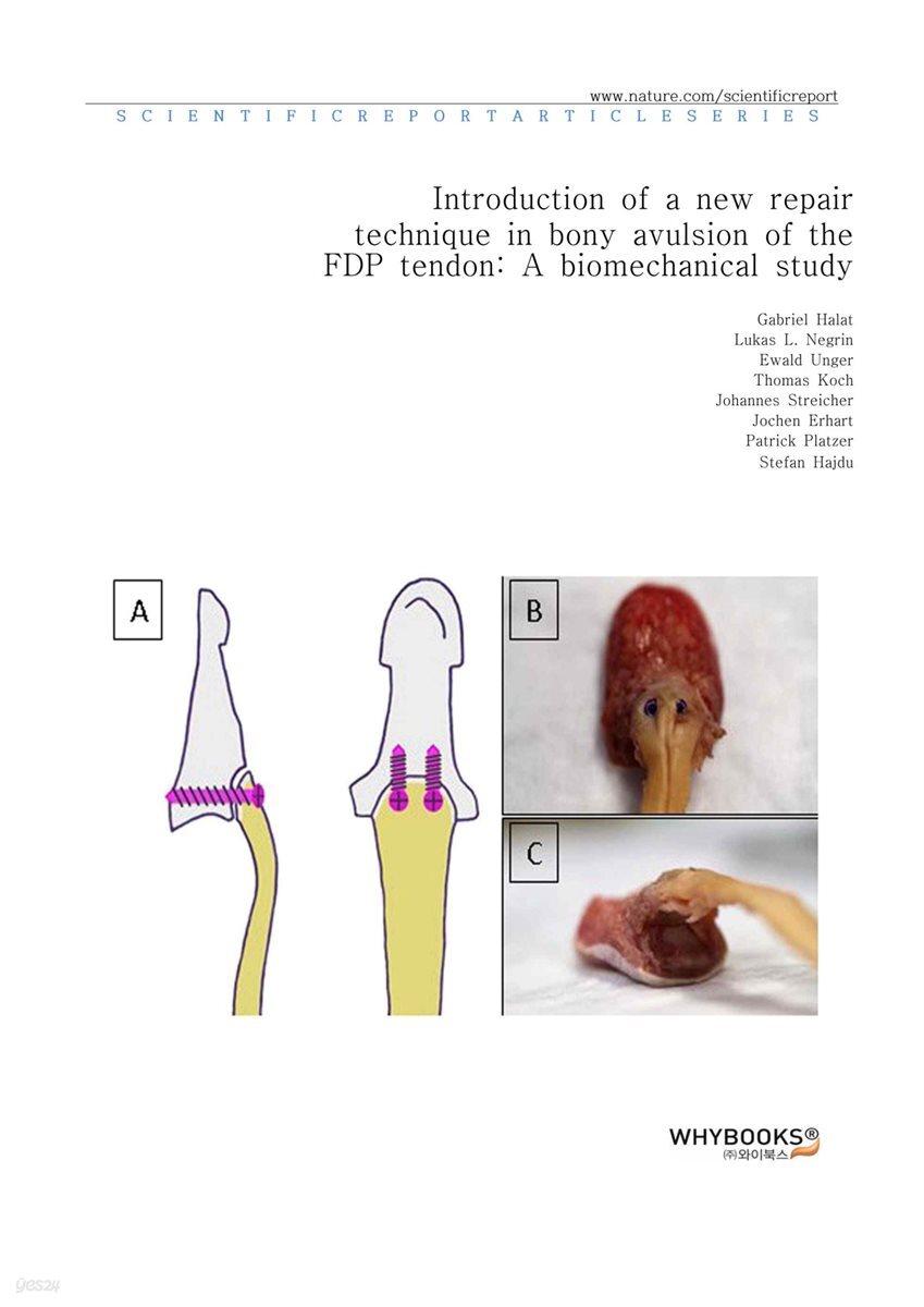 [전자책] Introduction of a new repair technique in bony avulsion of the ...